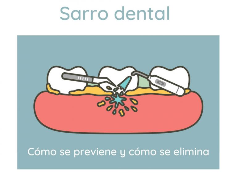 ¿Tienes Sarro en los dientes? Averigua cómo se elimina